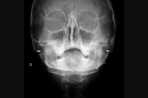 Radiografia de Waters | Diagnóstico odontológico por imagem com ...