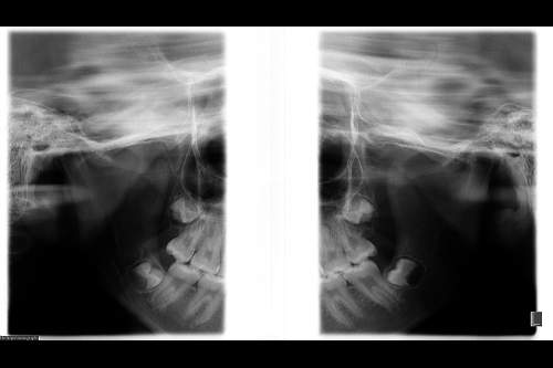 Radiografias de ATM | Diagnóstico odontológico por imagem com ...
